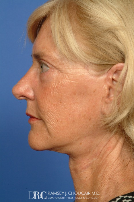 Face PATIENT 1 - Dr. Ramsey Choucair