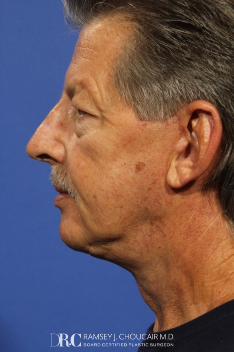 Face PATIENT 4 - Dr. Ramsey Choucair