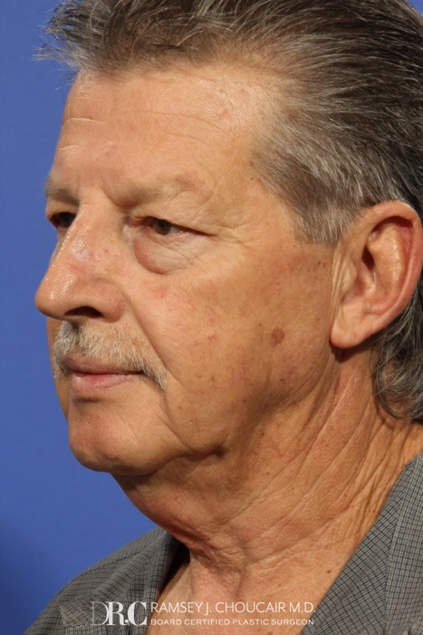 Face PATIENT 4 - Dr. Ramsey Choucair