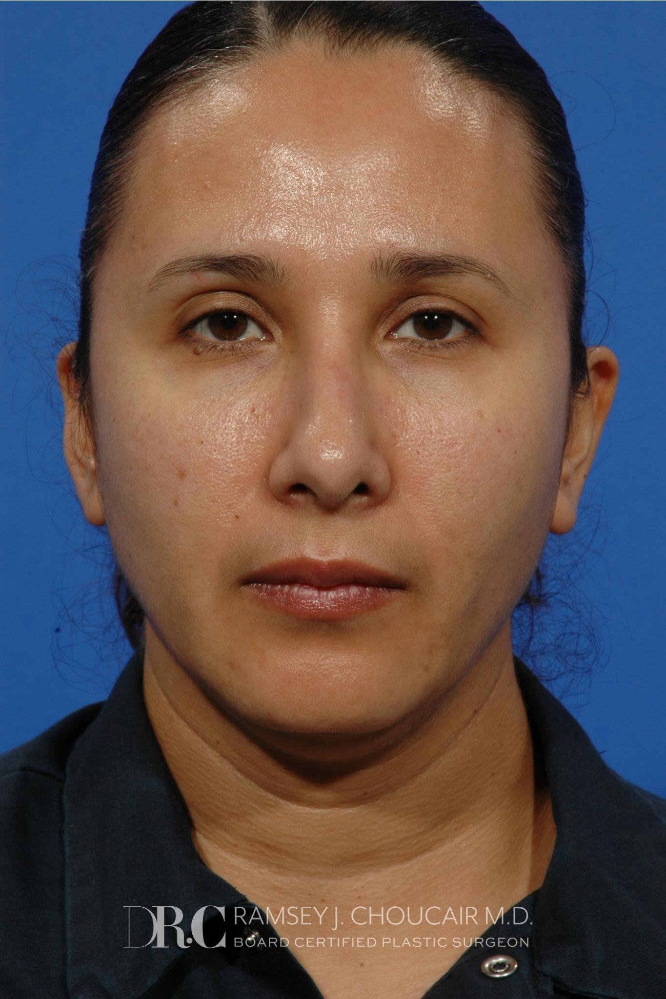 Face PATIENT 6 - Dr. Ramsey Choucair