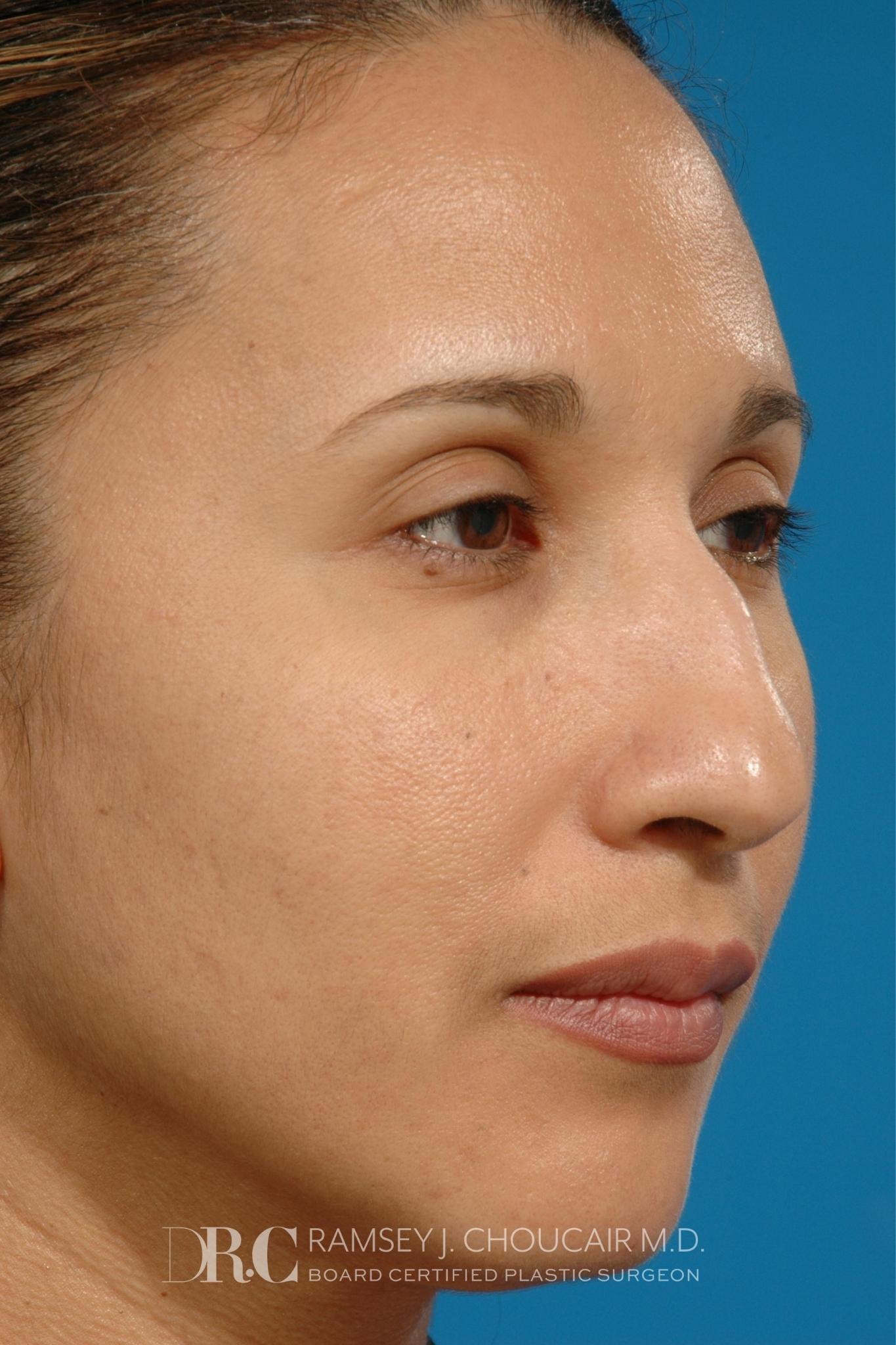 Face PATIENT 6 - Dr. Ramsey Choucair